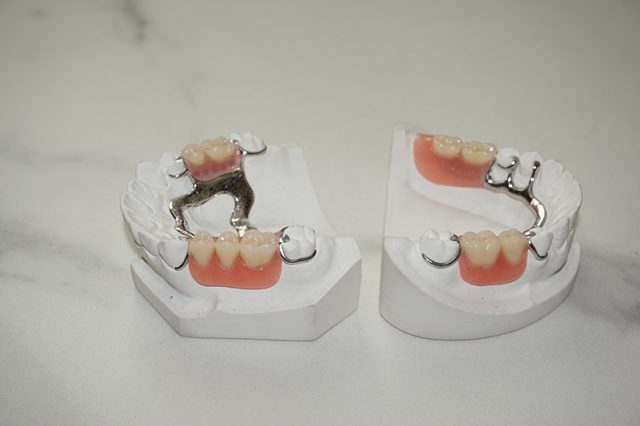 AVTAGBAR PROTETIK – Infinity Dental Lab